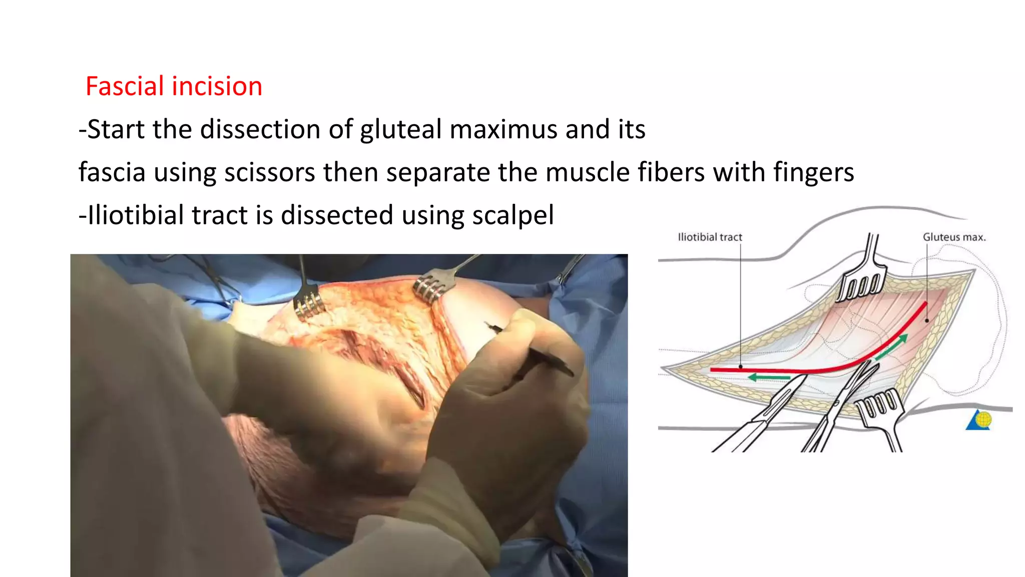 Kocher-Langenbeck acetabular approach | PPTX