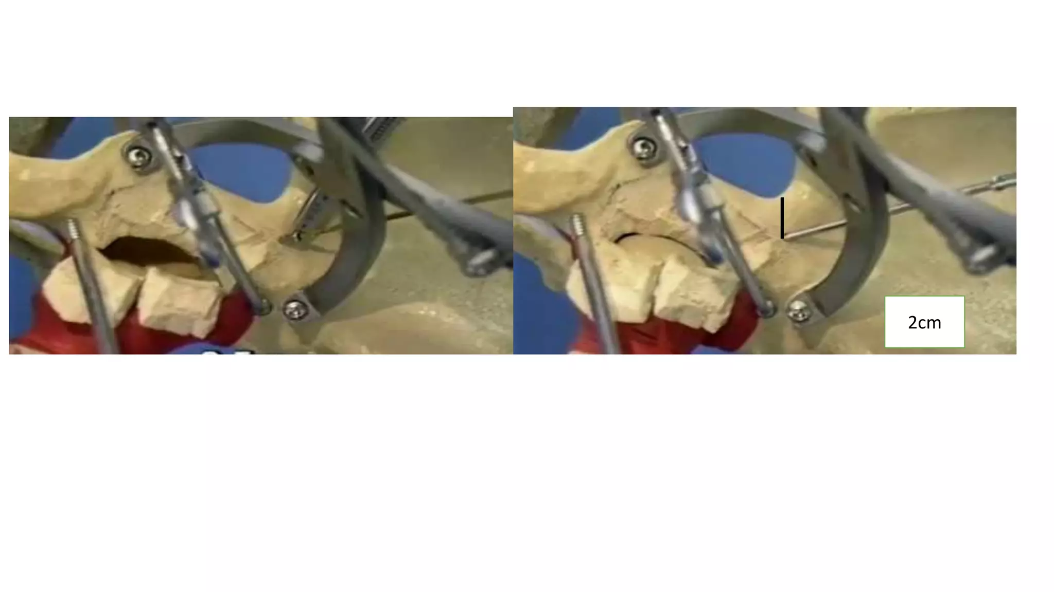 Kocher-Langenbeck acetabular approach | PPTX