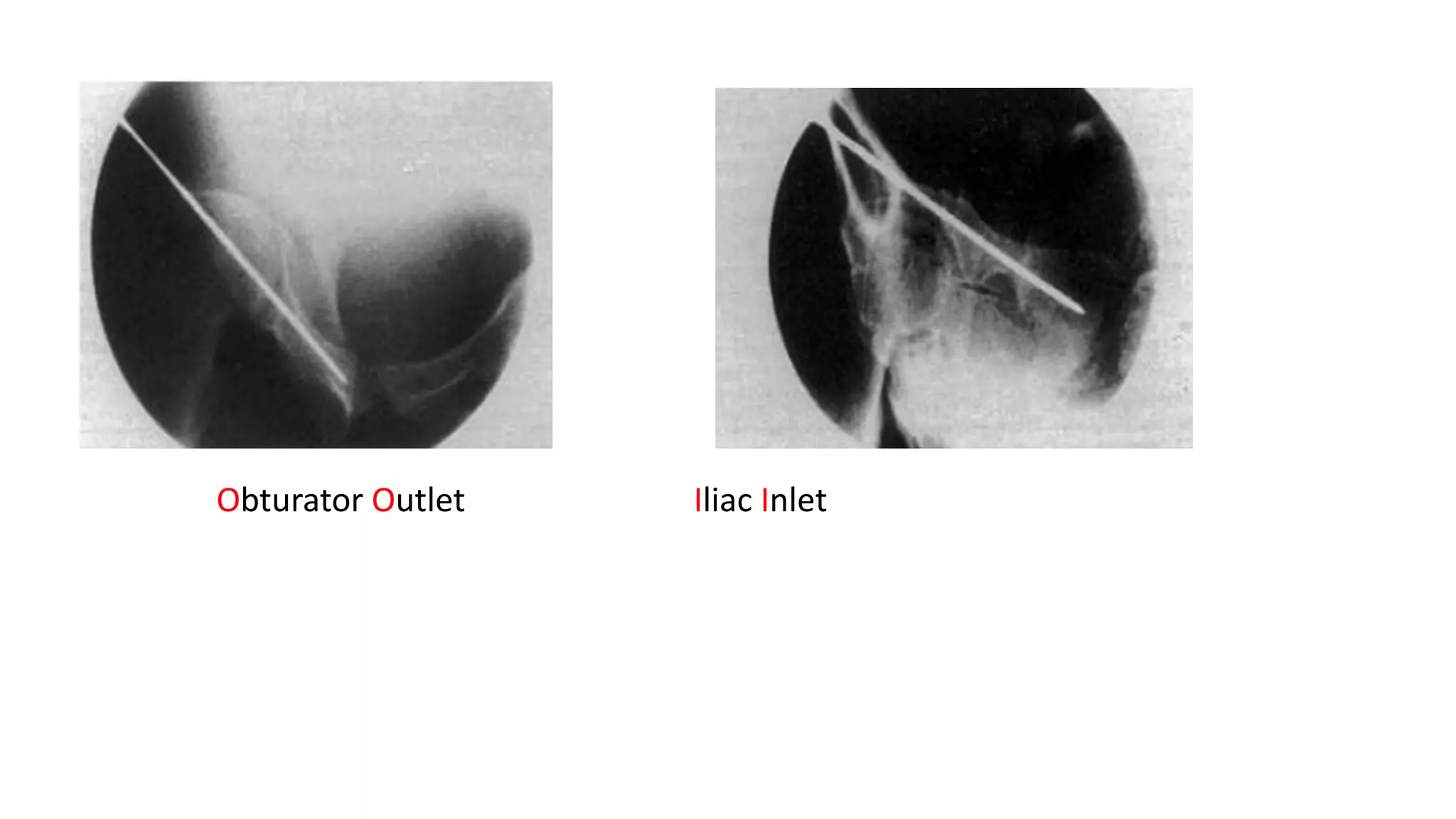 Kocher-Langenbeck acetabular approach | PPTX