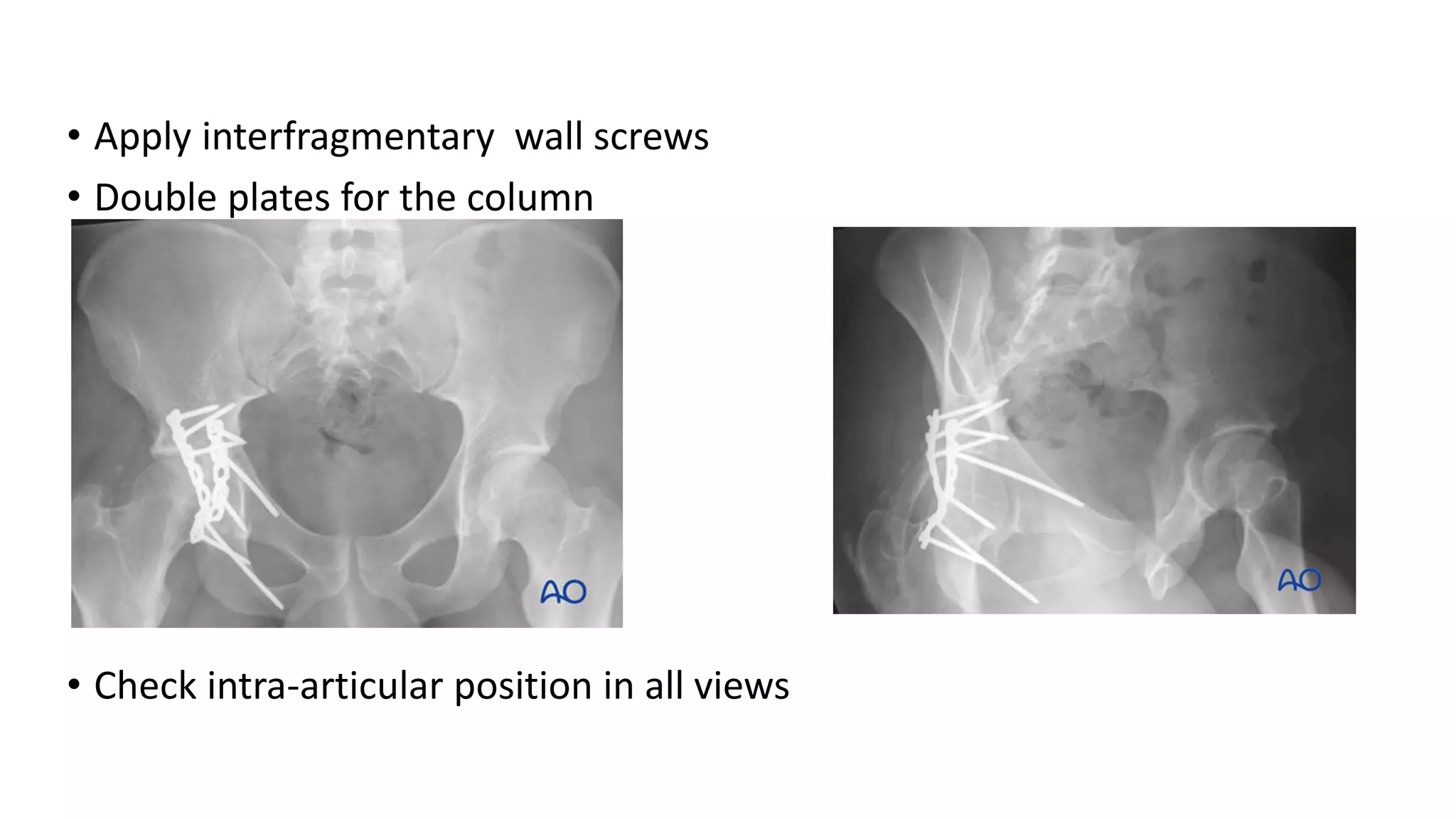 Kocher-Langenbeck acetabular approach | PPTX