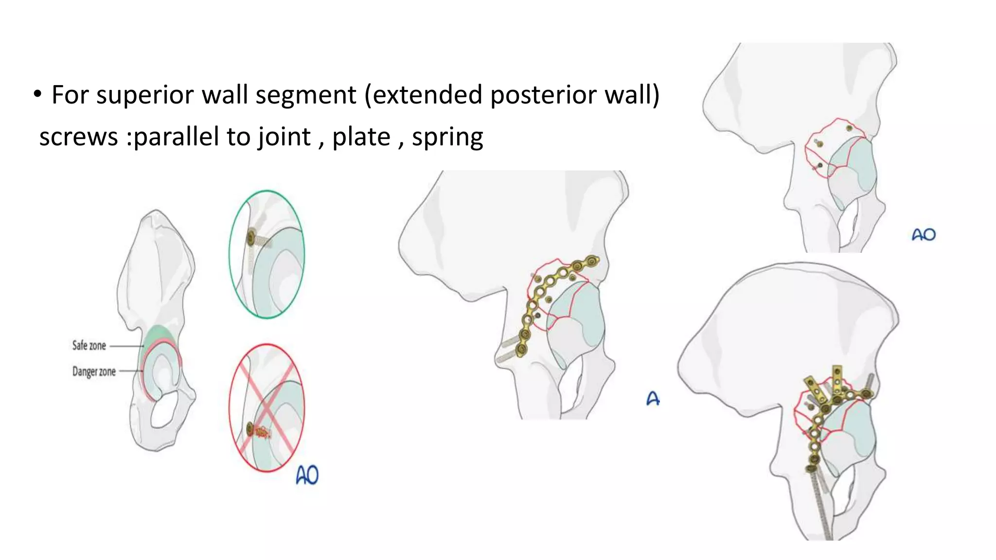 Kocher-Langenbeck acetabular approach | PPTX