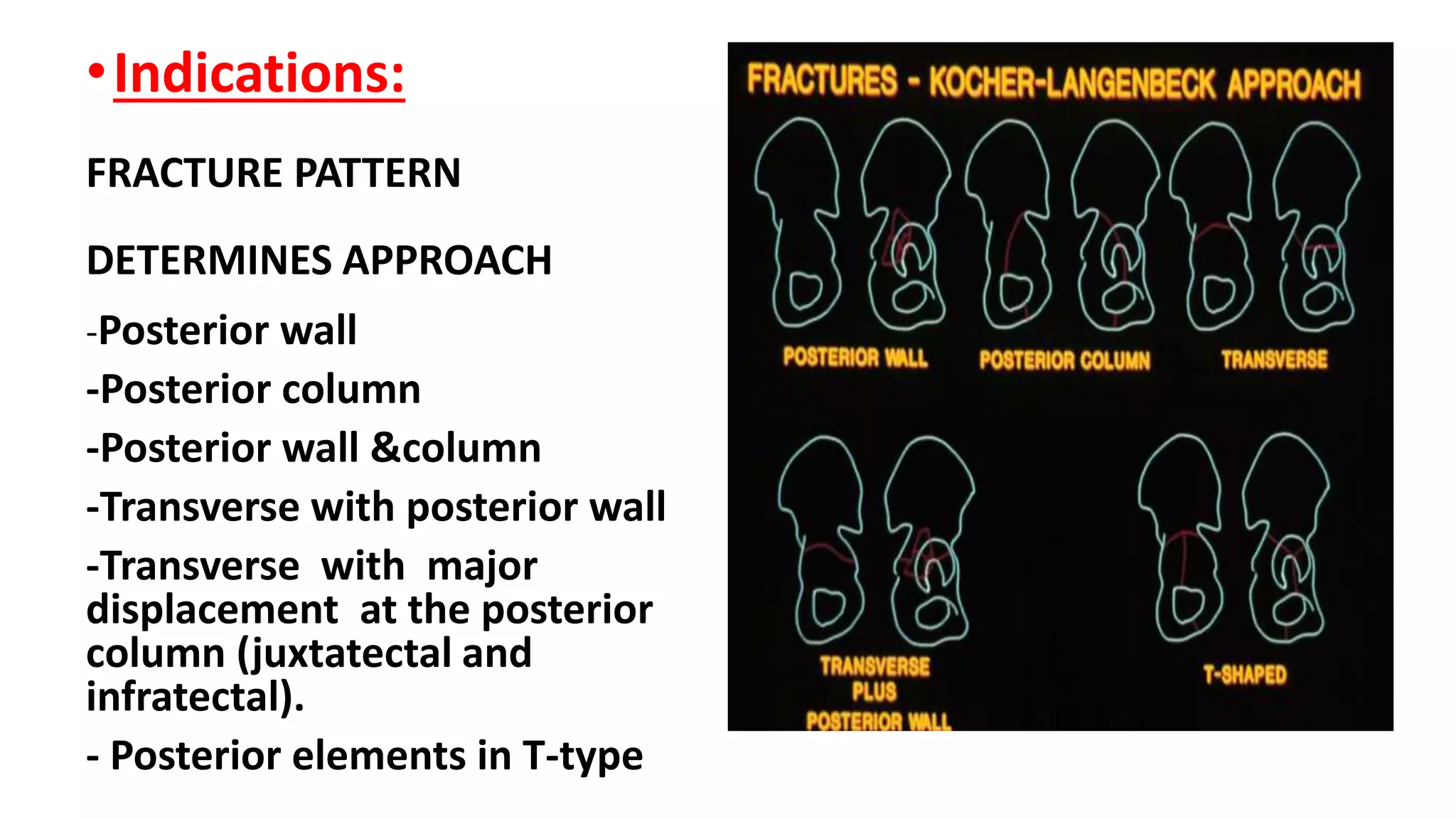Kocher-Langenbeck acetabular approach | PPTX