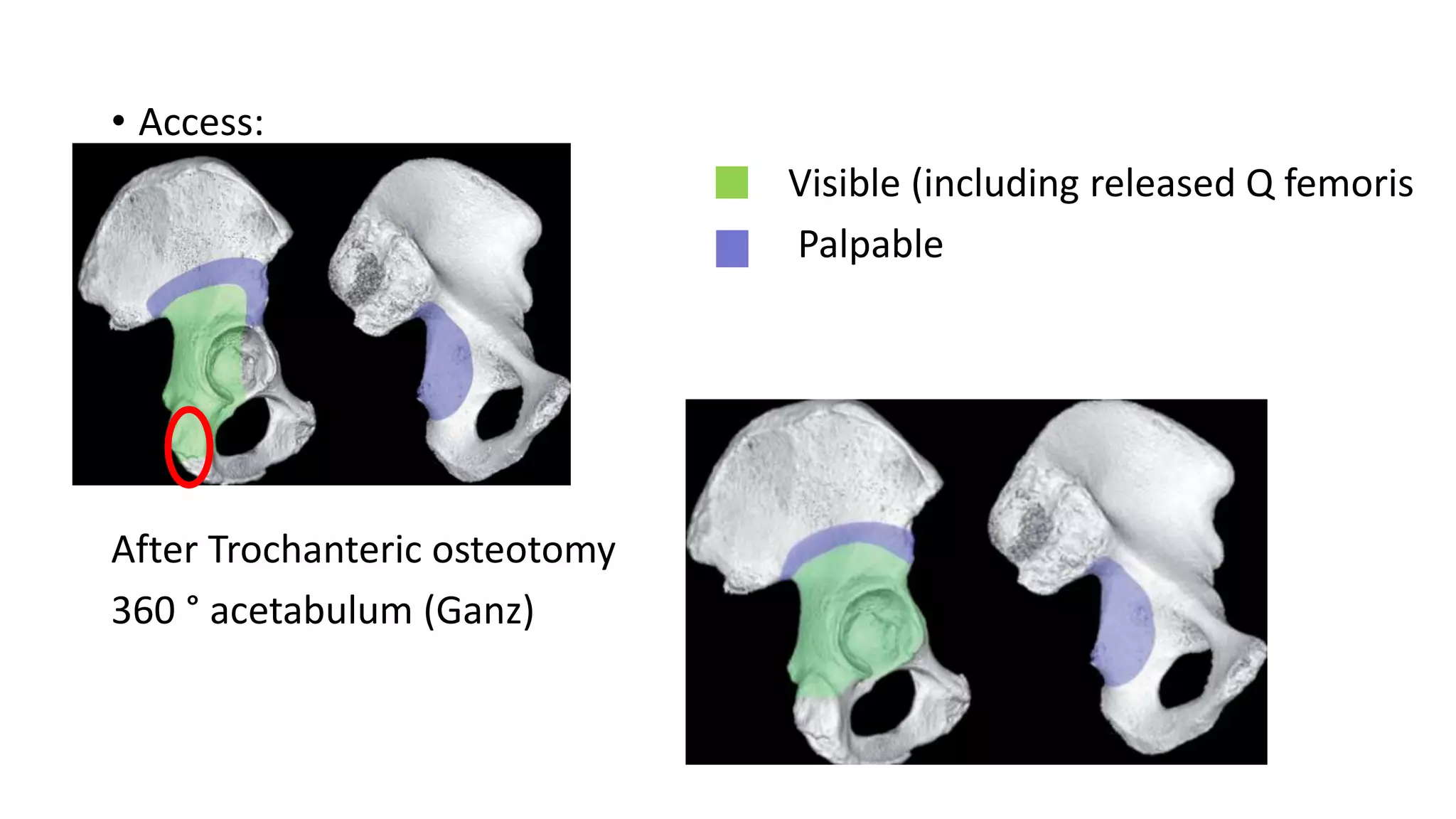 Kocher-Langenbeck acetabular approach | PPTX