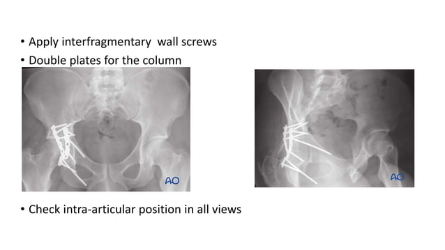 Kocher-Langenbeck acetabular approach | PPTX