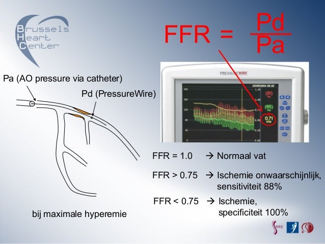 Dr Koen Erard & Dr Steven Vercauteren: FFR live - Fractioneel flow re…