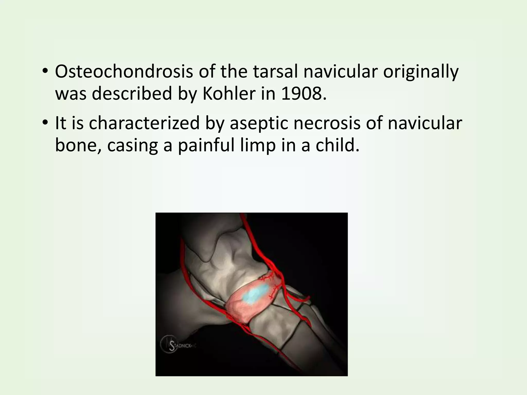 Kohler's disease | PPTX