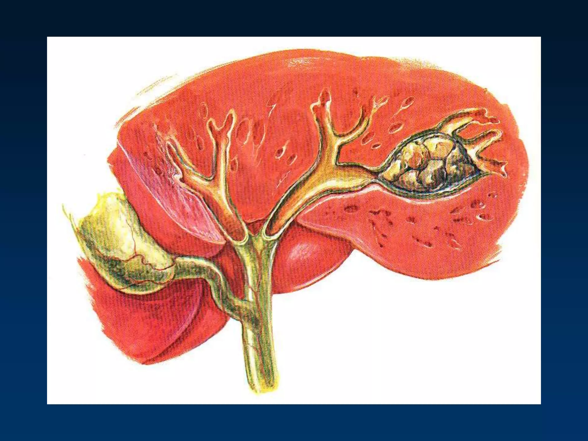 Kolelitiasis,kolestasis,kolesistitis | PPTX