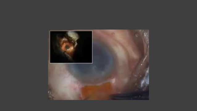 Advances in Manual Small Incision Cataract Surgery | PPTX | Eye and ...