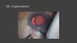 Advances in Manual Small Incision Cataract Surgery | PPTX