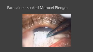 Advances in Manual Small Incision Cataract Surgery | PPTX