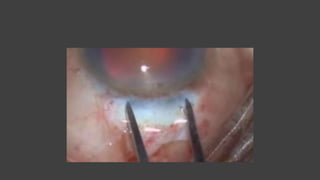 Advances in Manual Small Incision Cataract Surgery | PPTX