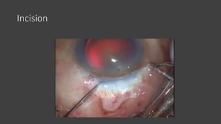 Advances in Manual Small Incision Cataract Surgery | PPTX