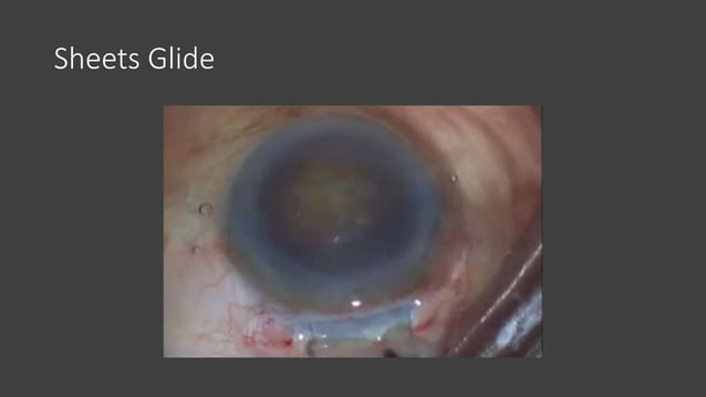 Advances in Manual Small Incision Cataract Surgery | PPTX | Eye and ...