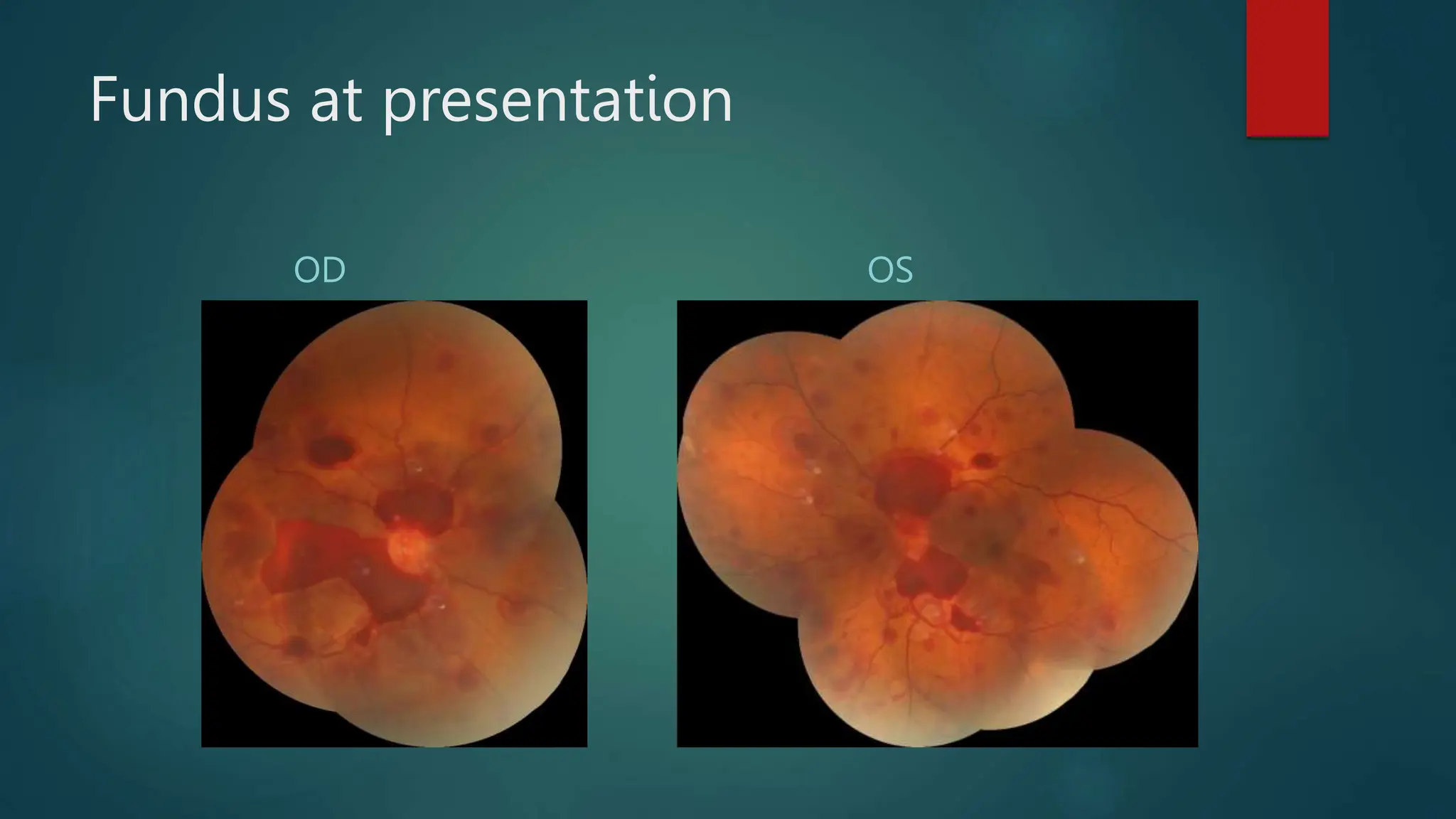 Kolkata Retina Conclave 2024 interesting cases | PPTX