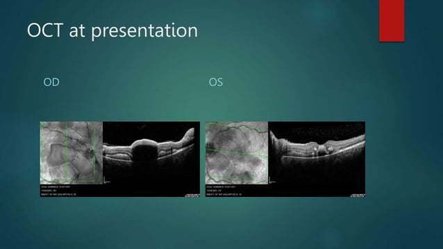 Kolkata Retina Conclave 2024 interesting cases | PPT