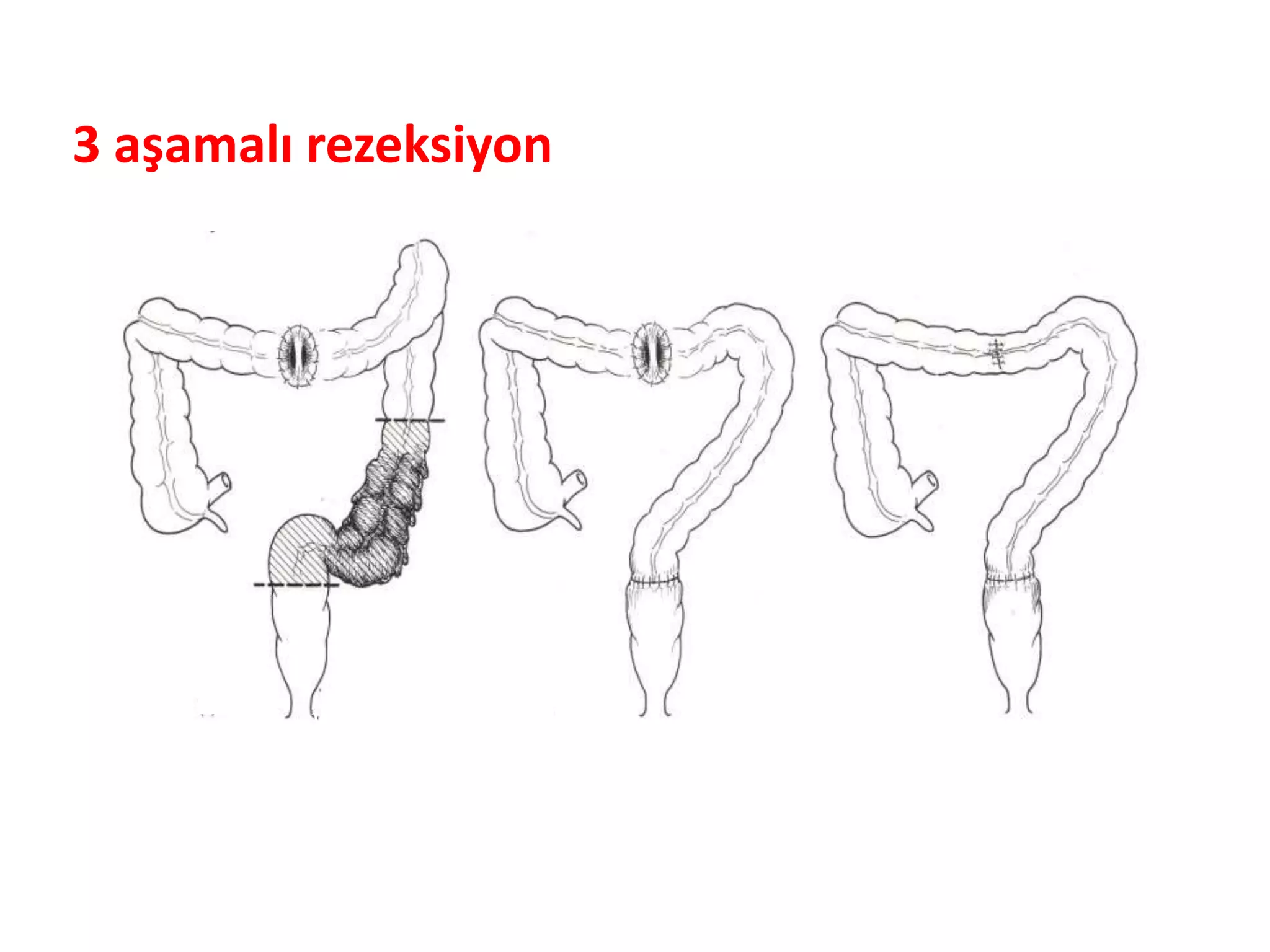 Kolorektal aciller mekanik barsak tıkanıklığı ileus | PPTX