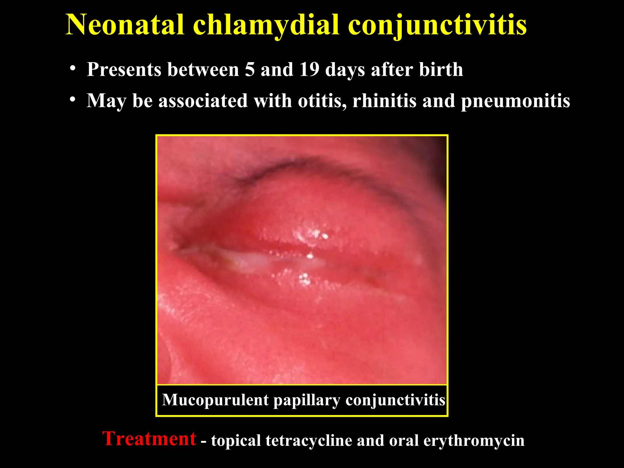 09 conjunctival infections | PPT