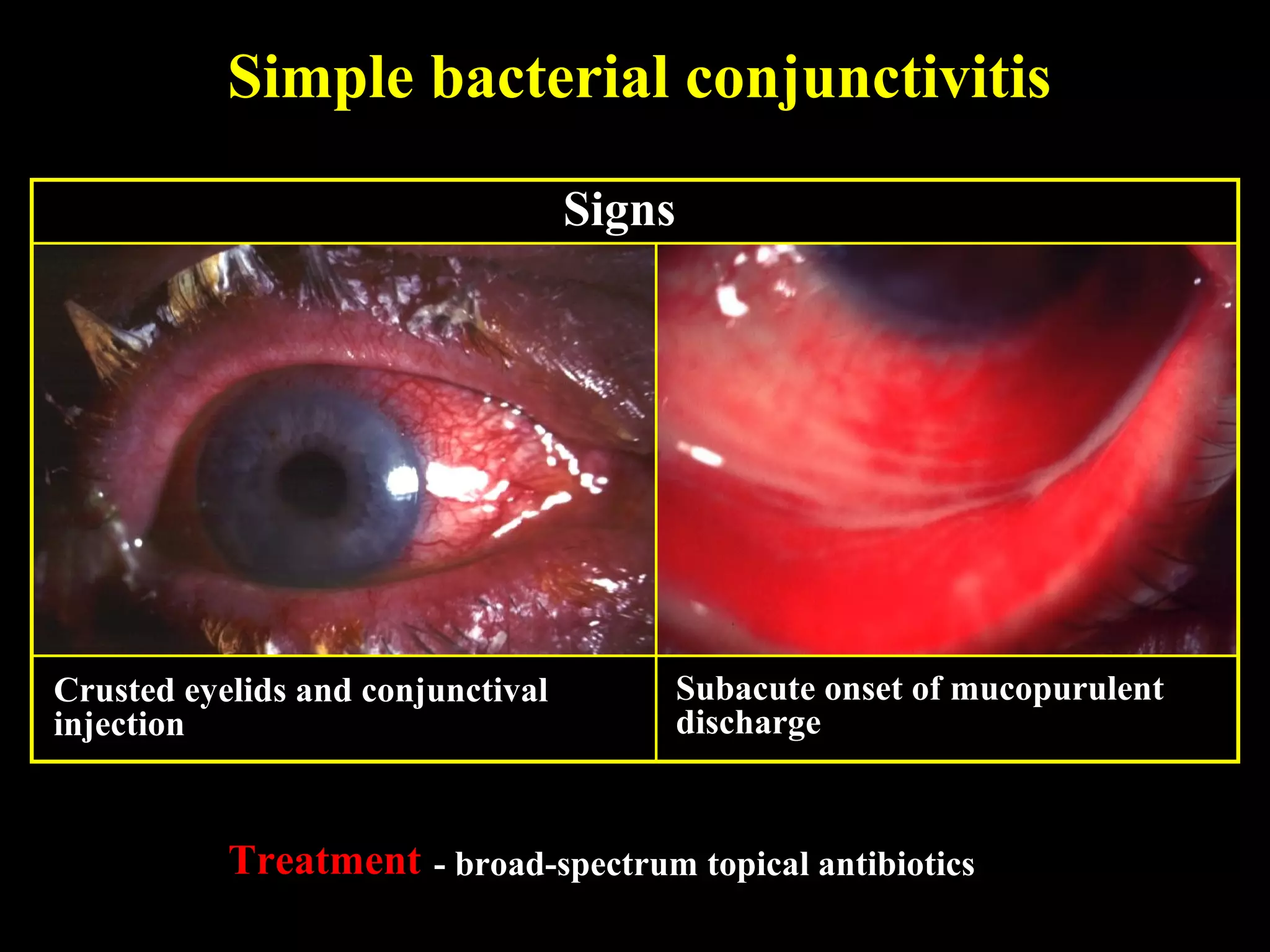 09 conjunctival infections | PPT