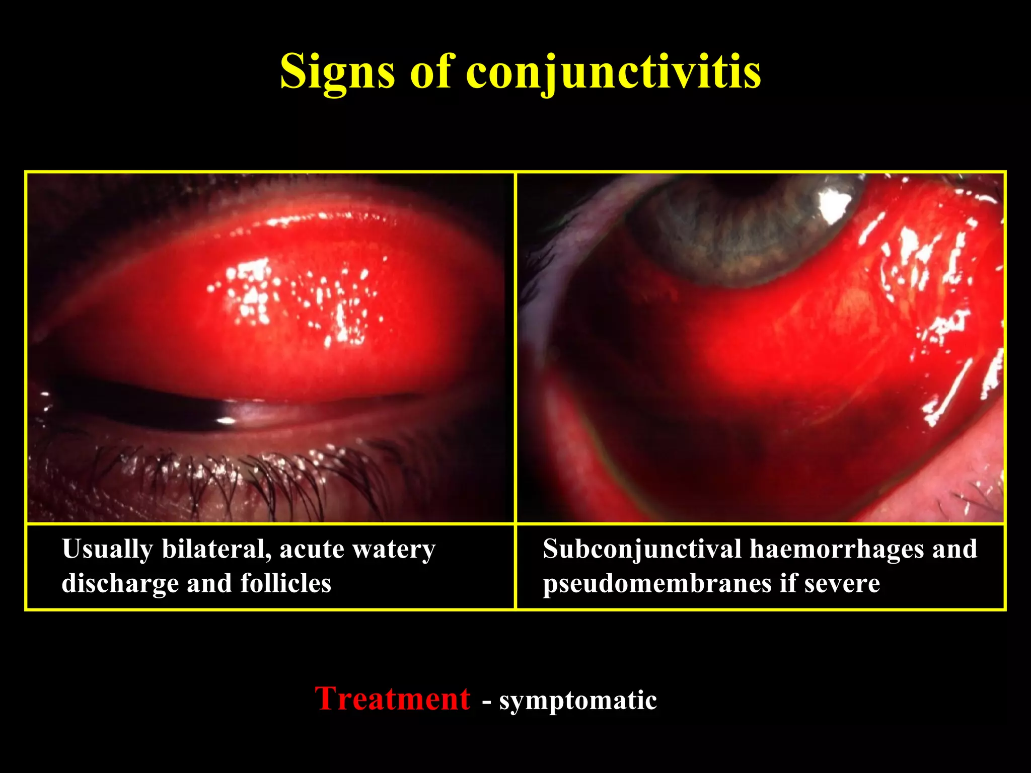 09 conjunctival infections | PPT