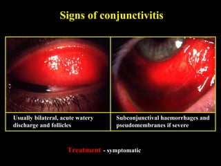 09 conjunctival infections | PPT