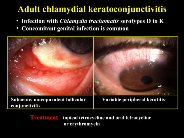 09 conjunctival infections | PPT