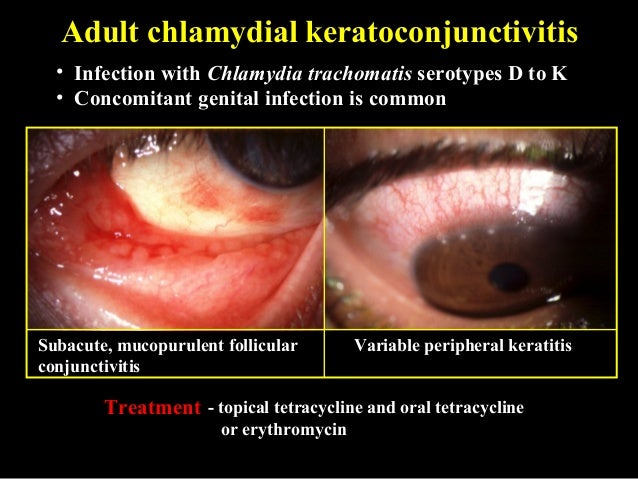 09 conjunctival infections