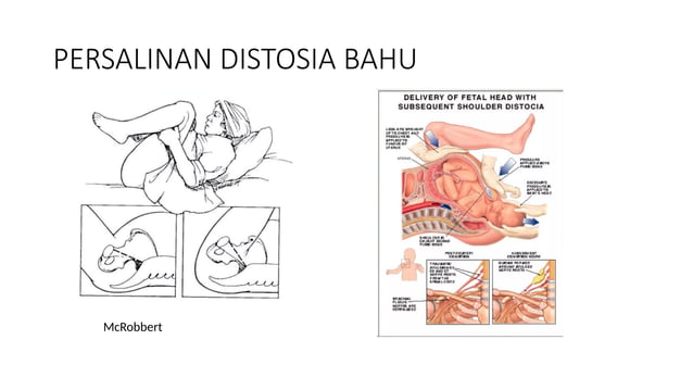 PPT PPT KOMPLIKASI DALAM PERSALINAN.pptx