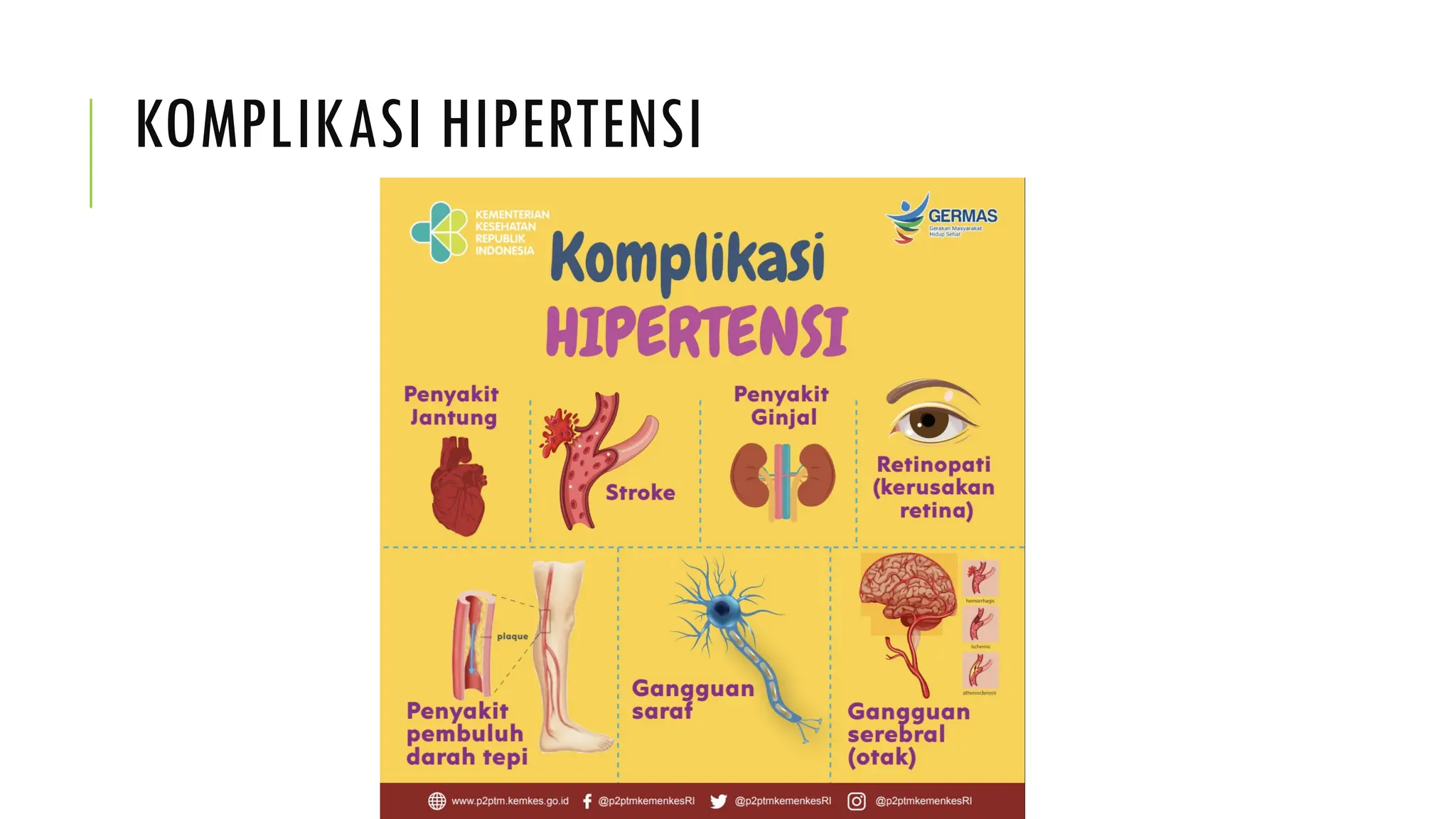 Komplikasi DM dan hipertensi dalam integrasi pelayanan kesehatan | PPTX