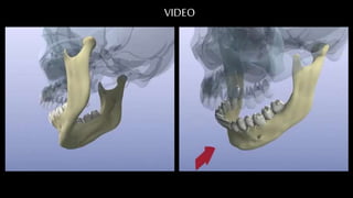 Kondil Fraktürleri | PPTX