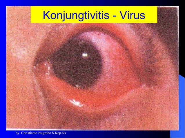 Konjungtivitis | PPT