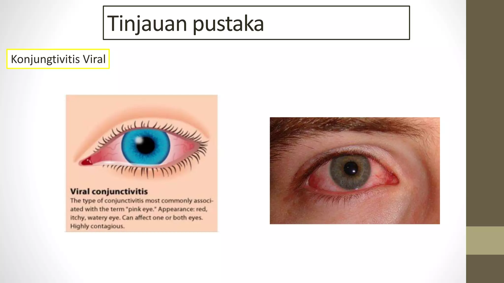 Konjungtivitis.pptx