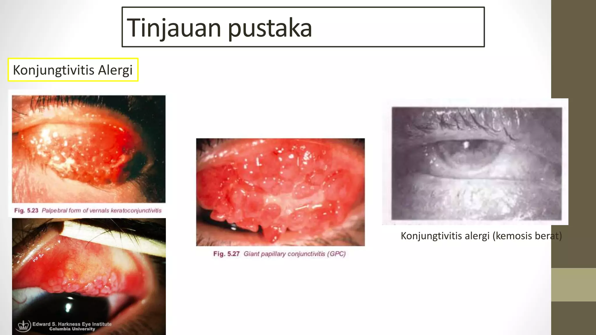 Konjungtivitis.pptx
