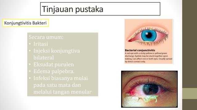 Konjungtivitis.pptx