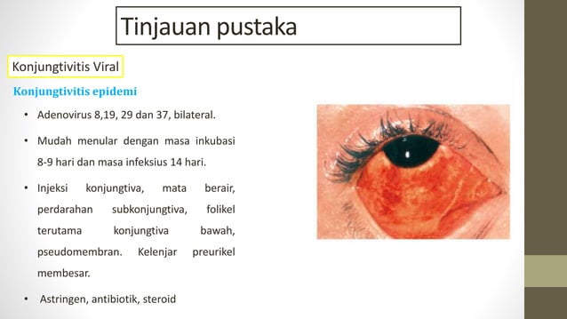 Konjungtivitis.pptx