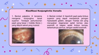 Konjungtivitis Vernalis 3.pptx