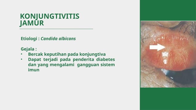 KONJUNGTIVITIS VIRAL PRESENTASI STASE MATA | PPTX