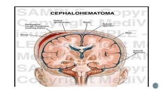 Konsep dasar neonatus dengan jejas persalinan | PPTX