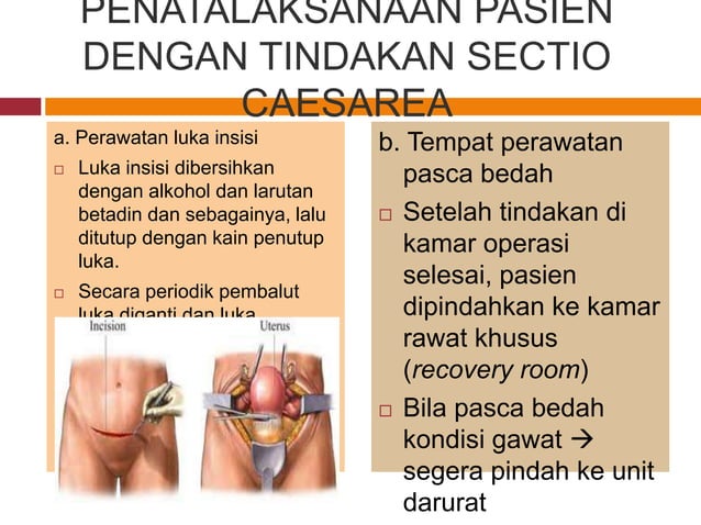Konsep Dasar Sectio Caesarea | PPTX