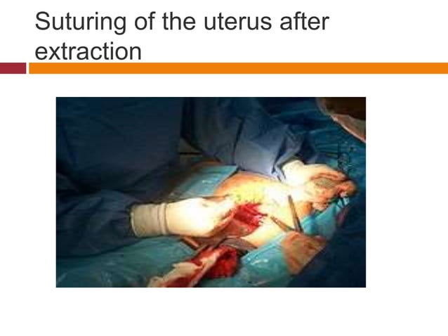 Konsep Dasar Sectio Caesarea | PPTX