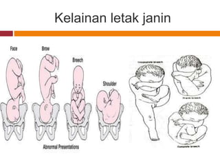 Konsep Dasar Sectio Caesarea | PPTX