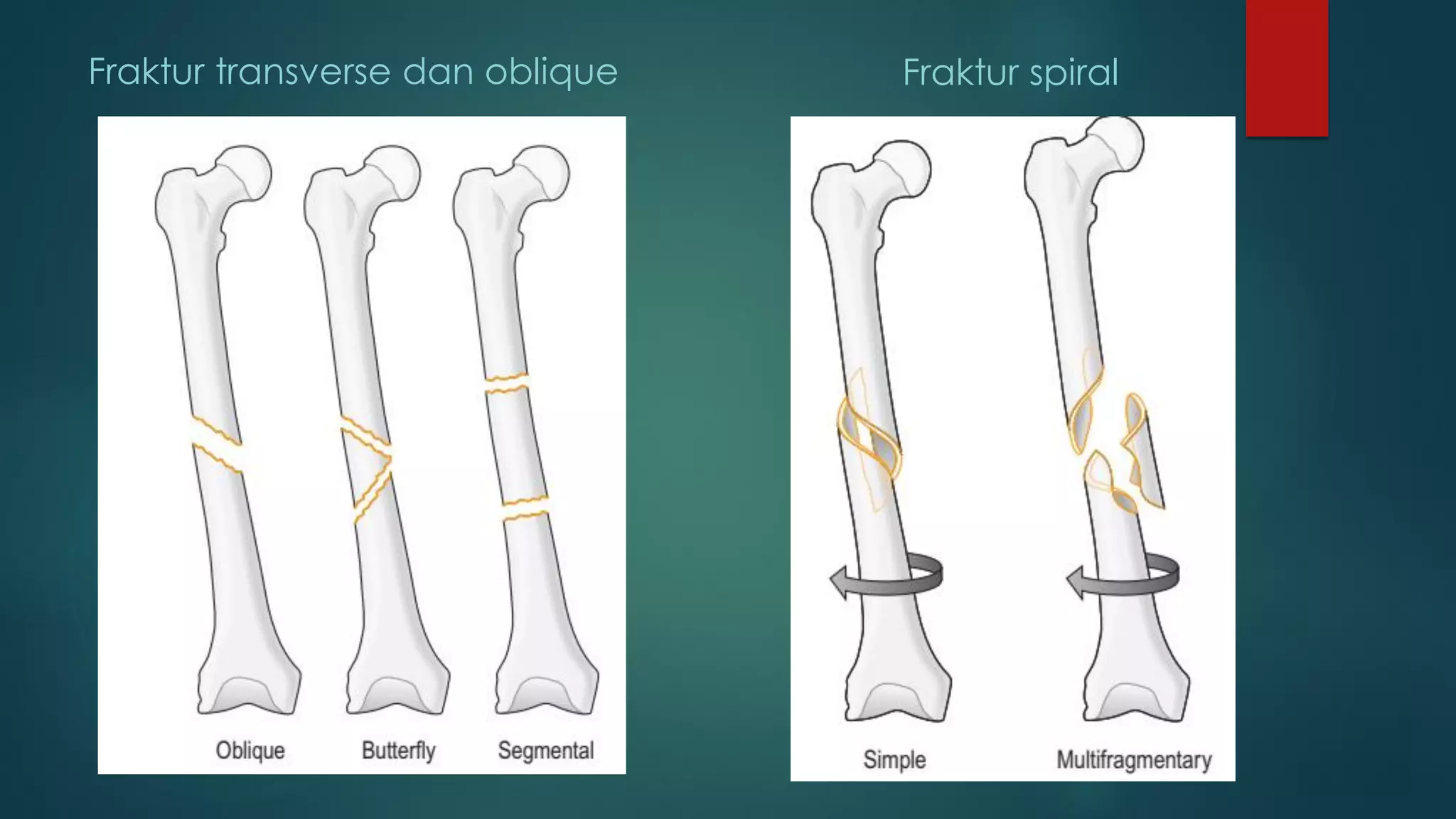 Konsep Fraktur | PDF