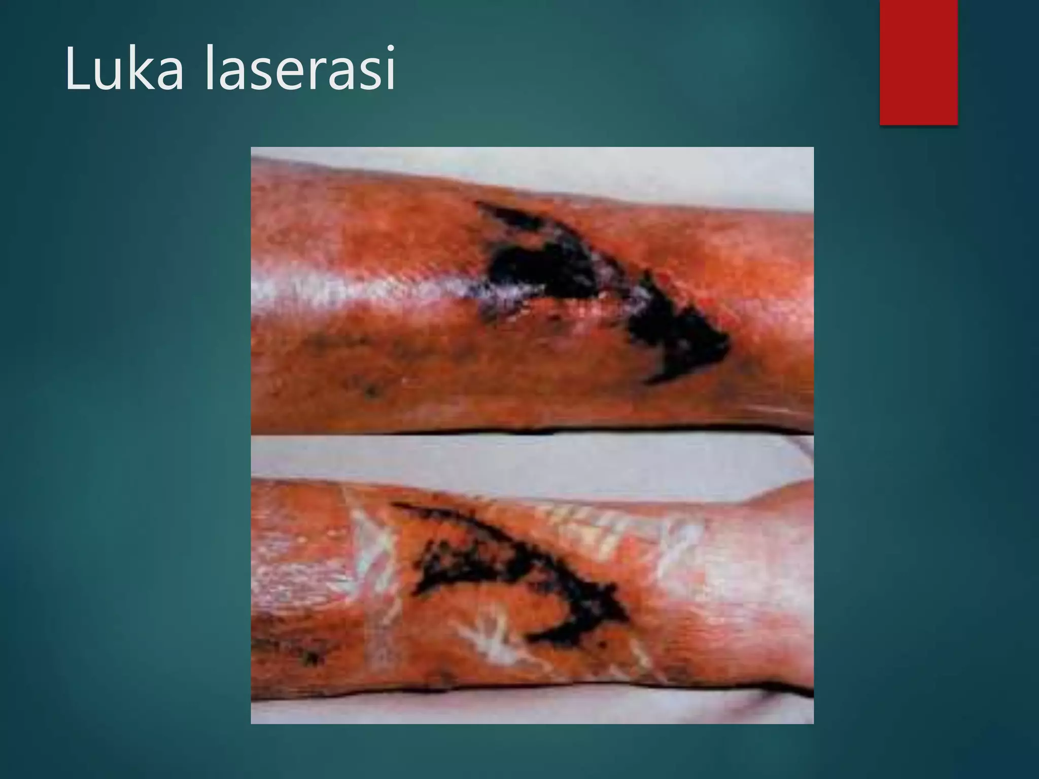 Konsep luka traumatic | PPT