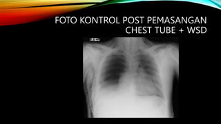 KOREKSI JAGA 3 - MR 120223 OPEN Hemathothorax.pptx