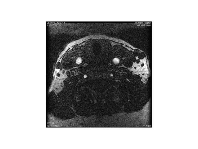 096 mri imaging of atherosclerosis using spio | PPT