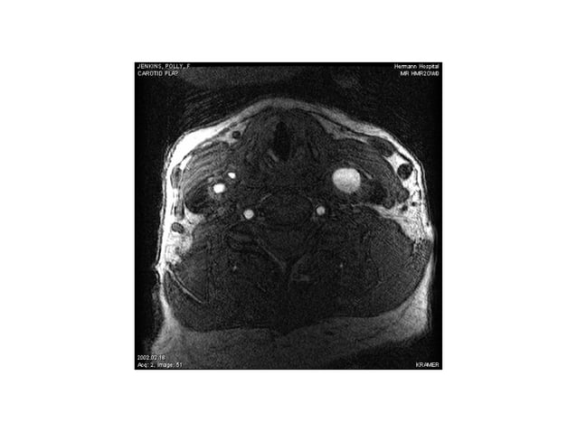 096 mri imaging of atherosclerosis using spio | PPT