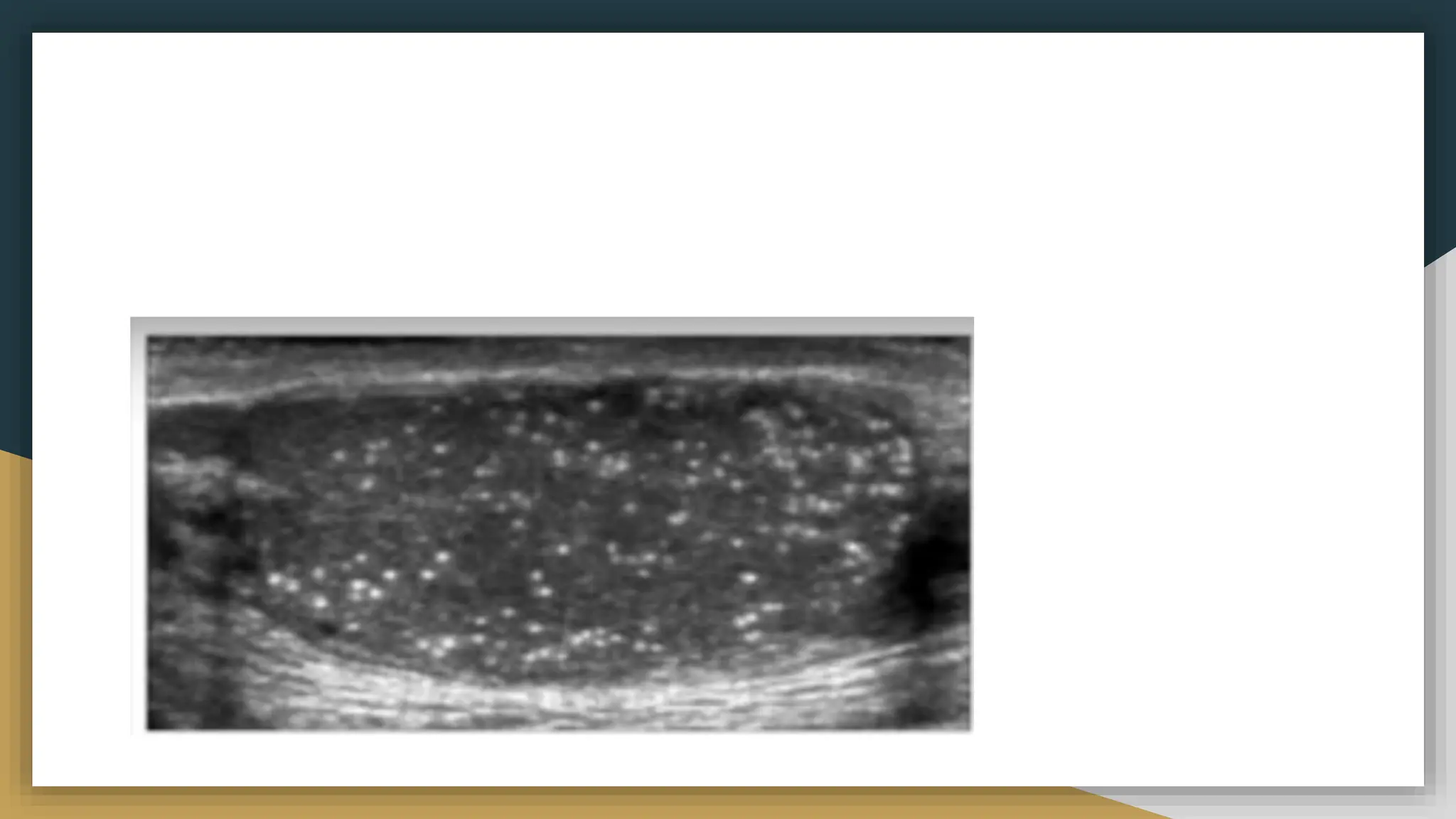 HIDROCELE Y VARICOCELE EN IMAGENOLOGIA RADIOLOGICA | PPT