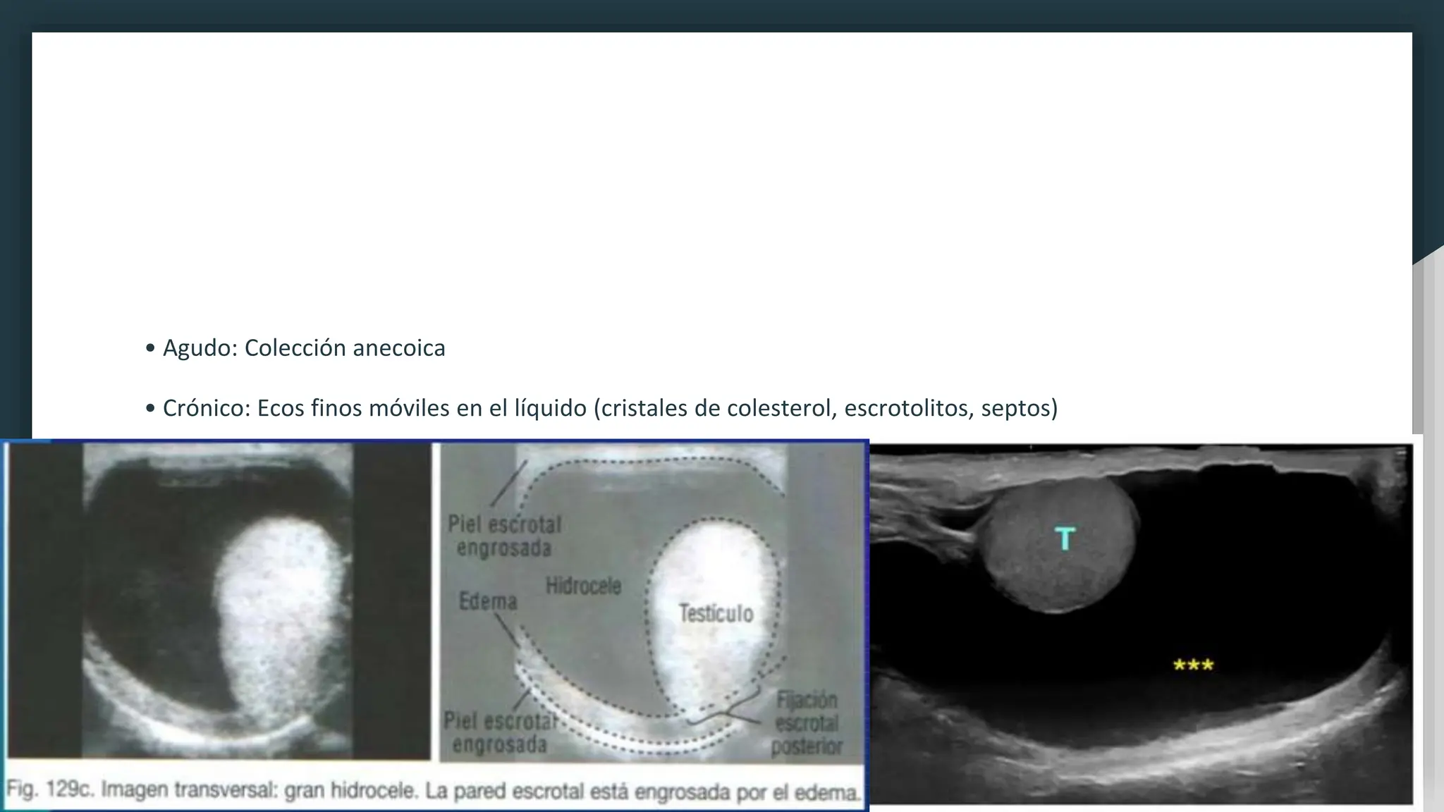Hidrocele Y Varicocele En Imagenologia Radiologica Ppt