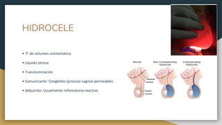 HIDROCELE Y VARICOCELE EN IMAGENOLOGIA RADIOLOGICA | PPT