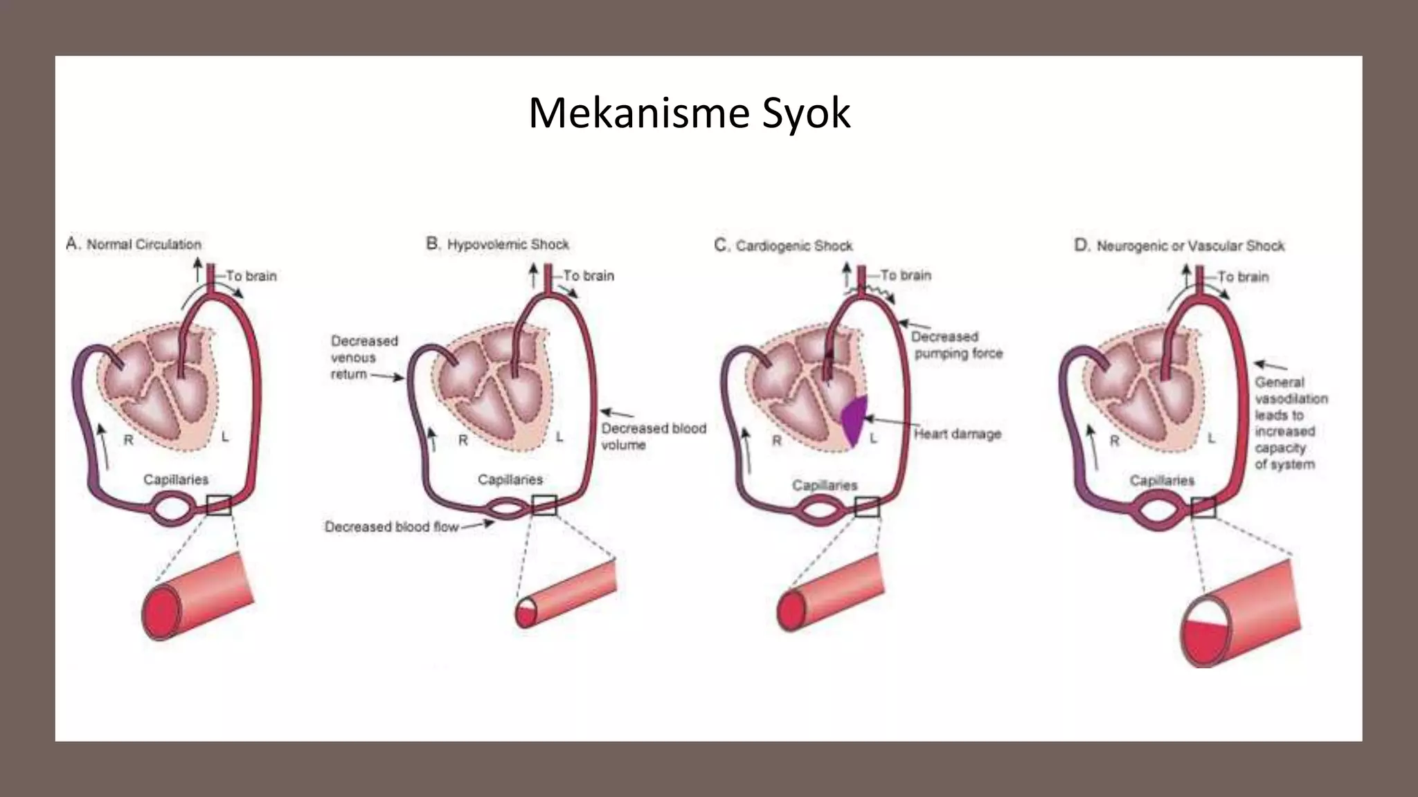 KP 2.3.4.5 Tatalaksana Syok Kardiogenik Update 2021.pptx