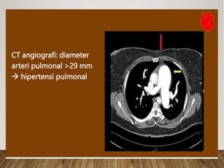 cor pulmonale for humanity faculty medicine | PPTX